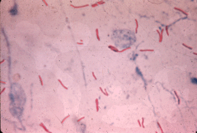 Mycobacterium Tuberculosis Gram Stain