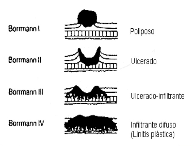Clasificación de Borrman en cáncer gastrico
