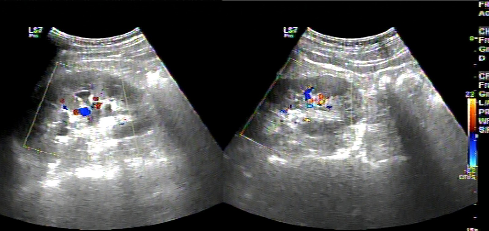 Retroperitoneal Bleed Ultrasound