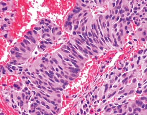 [Pathology] Atlas of Moderately Differentiated Neuroendocrine Carcinoma ...