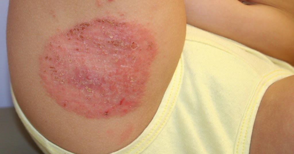 dr.Lestari Rahmah, MKT: TINEA CRURIS