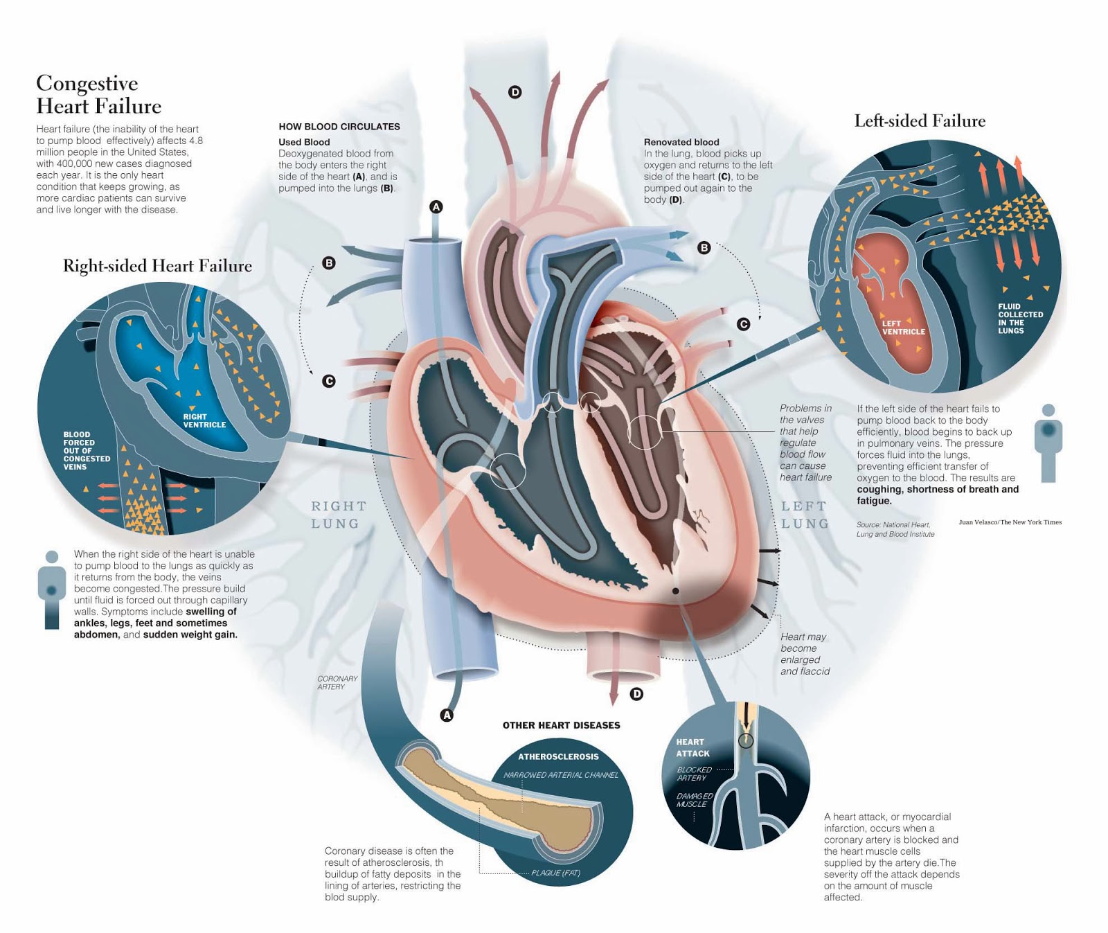 Estudos em Enfermagem: Infographics - Congestive Heart Failure