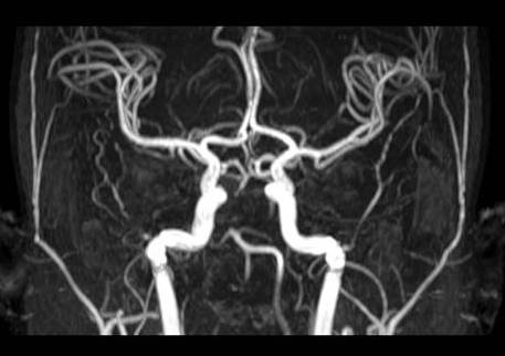 Basilar Artery Thrombosis-MRI - Sumer's Radiology Blog