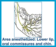 Doctors Gates: Local anesthesia for a complex lower lip laceration ...