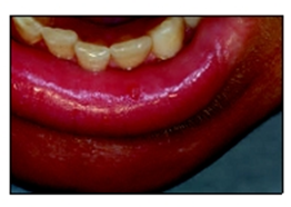 Healthy Ranula: Oral medicine-Aphthous and other common ulcers ...
