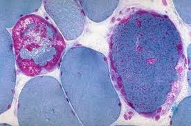 Medical Treatment Pictures-for Better Understanding: MERRF Syndrome