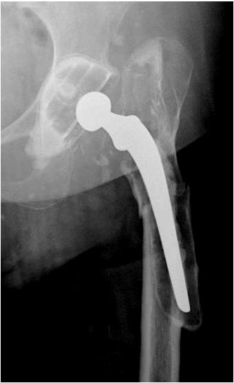 Joint Preservation and Replacement : Extended trochanteric osteotomy