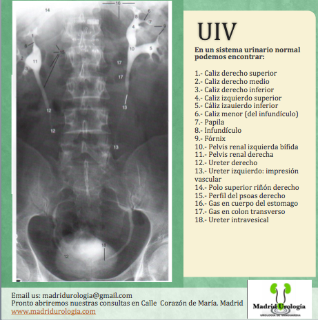 Madrid Urología: UROGRAFÍA INTRAVENOSA