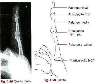 INCIDÊNCIAS LATERAL – LATERO MEDIAL OU MÉDIO- LATERAL: DEDOS