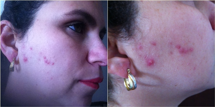 Meu Tratamento Contra Acne - Vamos ser Sinceras