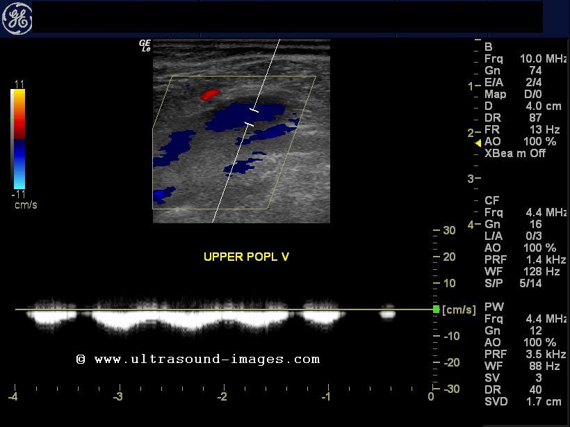 cochinblogs: Ultrasound imaging of popliteal vein thrombosis