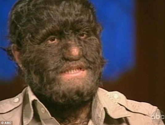 welcome to martha igene blog: Wolfman' with rare condition that causes ...