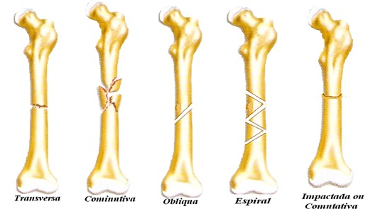 Fratura Óssea e os cuidados de Enfermagem ~ Enfermagem