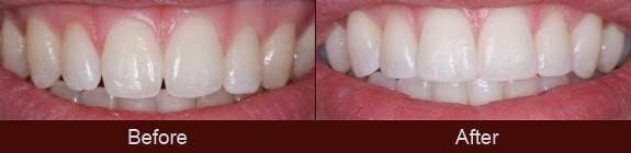 :: Dallas Dentistry: Composite Tooth Bonding in Dallas