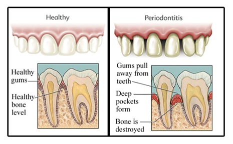EKDANTAM DENTAL CLINIC: Reasons And Treatment Of Pain On Teeth Biting