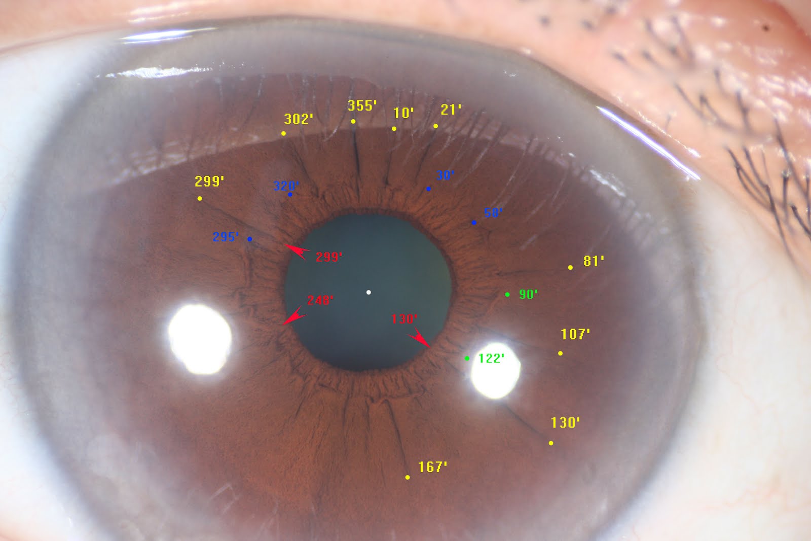 Modern & Multidimensional Iridology: Radial Furrows, Hyperlastic ...