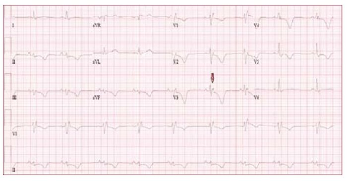 Absorb Medicine: Epsilon Waves in Arrhythmogenic Right Ventricular ...