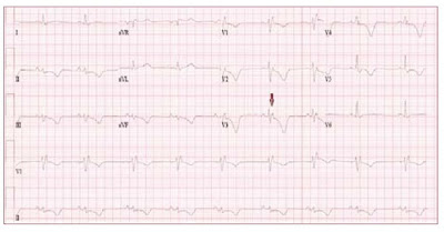 Absorb Medicine: Epsilon Waves in Arrhythmogenic Right Ventricular ...