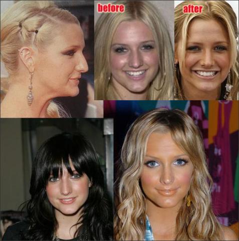 Ashlee Simpson Nose Job