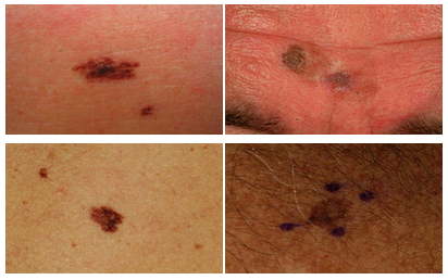 Qualitytime: Wat is een melanoom?