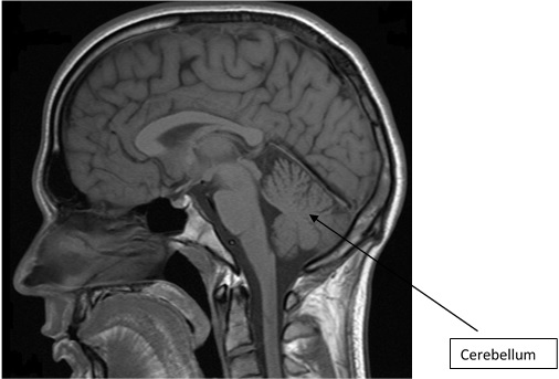 Cerebellar Agenesis - Luke Savoie: Luke's MRI