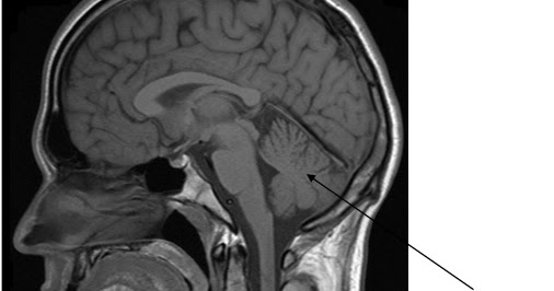 Cerebellar Agenesis - Luke Savoie: Luke's MRI