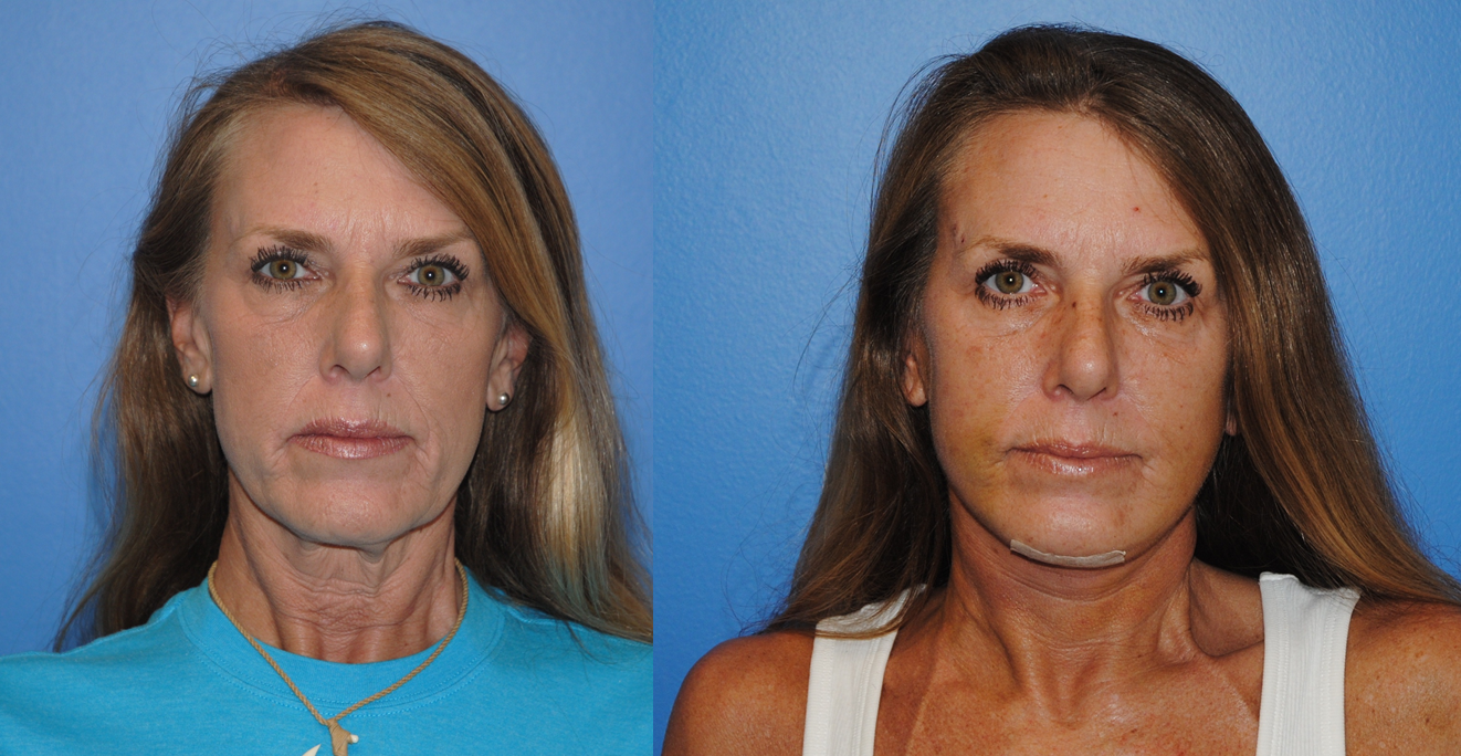 Facial Fractures, Facial Trauma, Facial Reconstruction