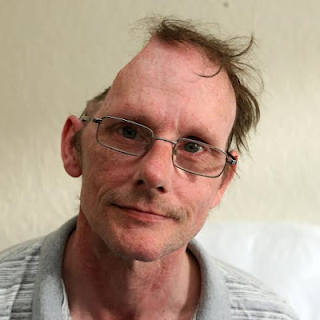 Man with half-head complains after his £195 a week benefits is slashed ...