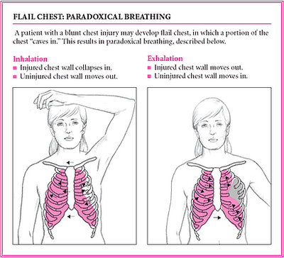 Blunt-Force Trauma : Interventions for Flail Chest