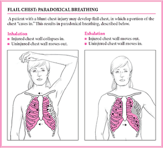 Blunt-Force Trauma : Interventions for Flail Chest