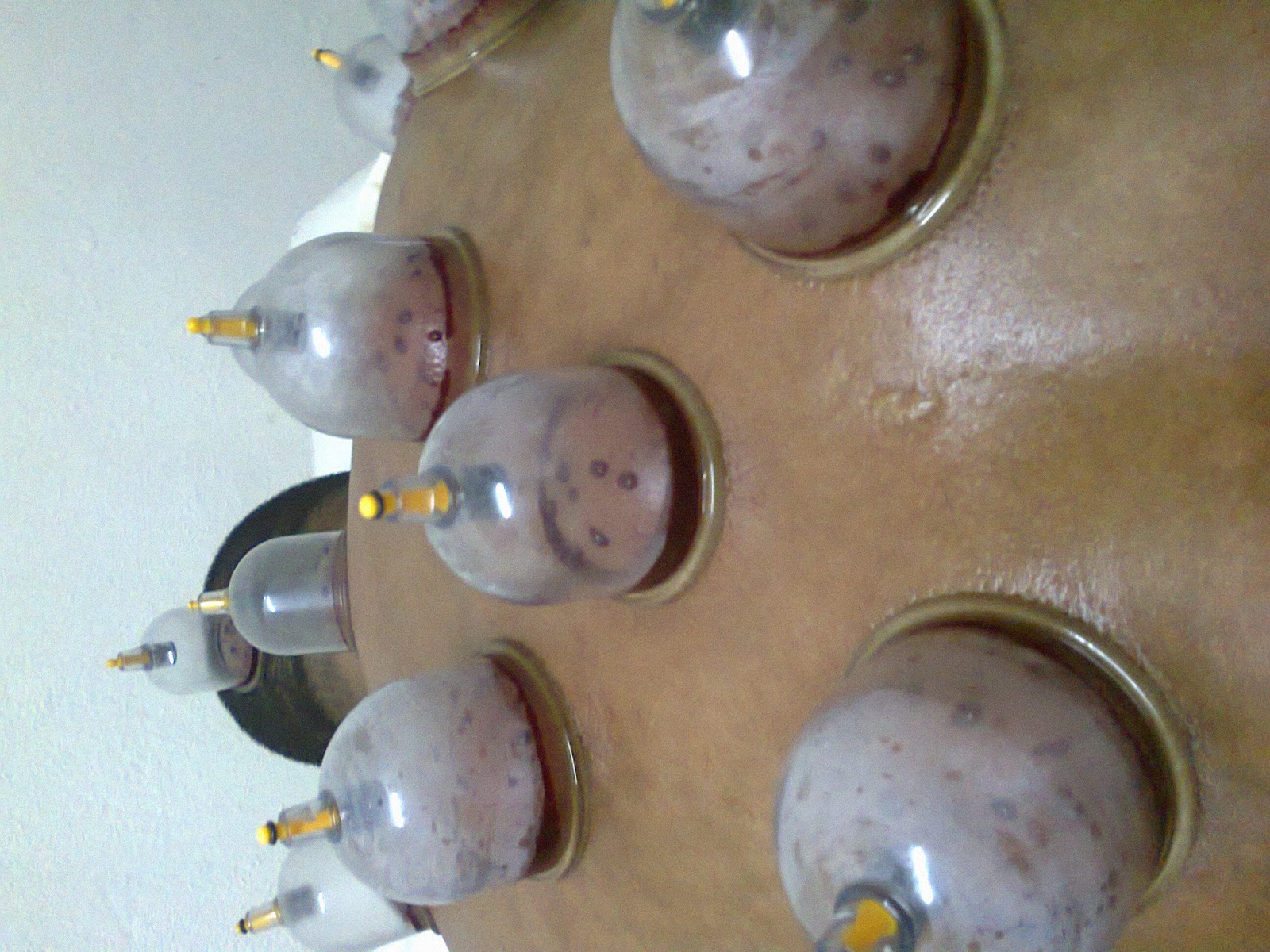 AL JANNAH PUSAT RAWATAN BEKAM DAN AKUPUNTUR KELANTAN: bekam untuk ...