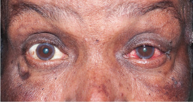 [Emergency] ATLAS OF ANTERIOR UVEITIS (IRITIS) | Free Medical Atlas