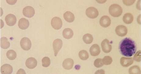 FICHERO HEMATOLOGIA : Dacriocito