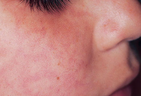 How to treat skin rashes