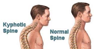 Kyphosis