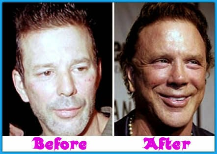 Mickey Rourke Face Plastic Surgery Gone Wrong Before and After Pictures