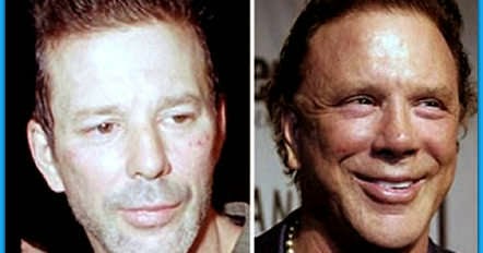 Original Mickey Rourke Facelift