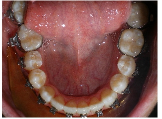Brace Yourself: Pre-surgery Thoughts & Too-Close Teeth Pictures
