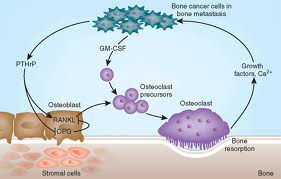 Bone Cancer & Treatment | Cancer Treatment USA