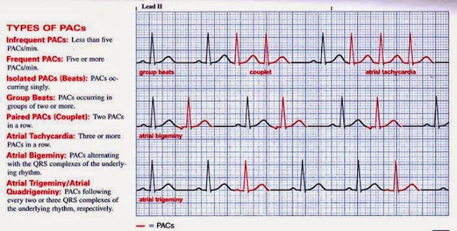 Premature Atrial Contraction / Atrial Ekstrasistol | INA - ECG