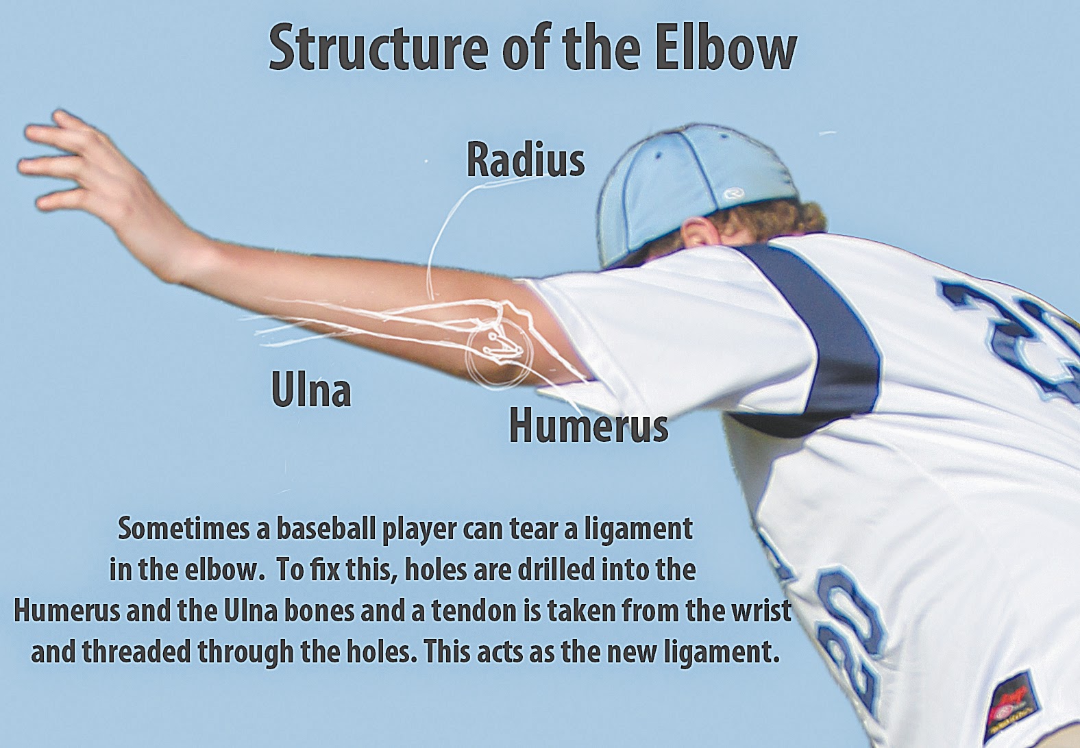 Baseball Dads: Tommy John surgery now routine in Major League Baseball ...