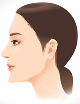 BK Plastic Surgery: [BK Plastic Surgery] Protruding Chin Correction