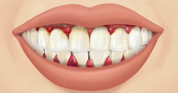 Best Review About Scurvy