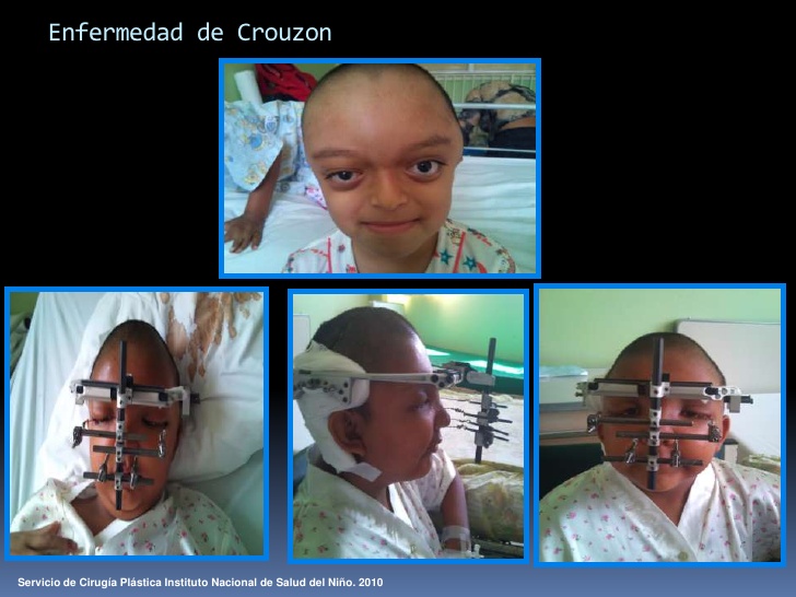 SÍNDROME DE CROUZON