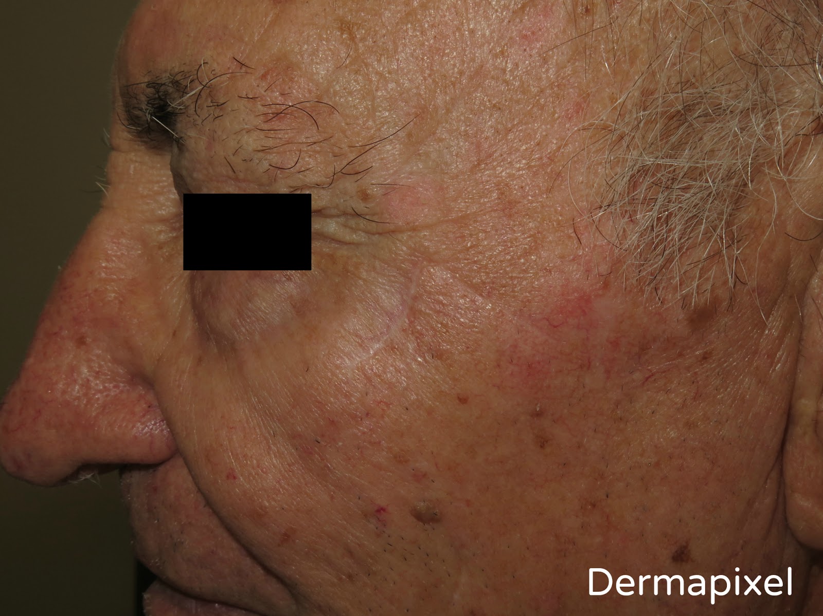 Dermapixel: Léntigo maligno: El melanoma light (pero melanoma al fin y ...