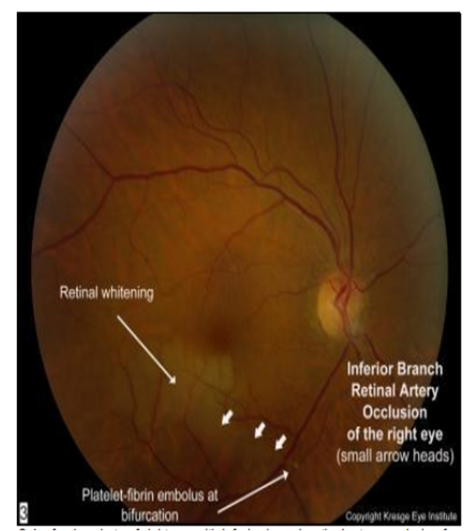 Branch Retinal Artery Occlusion - CatatanDokter