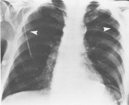 Centro de Terapia Semi-Intensiva Hospital de Clínicas - UFPR: TÓRAX DE ...