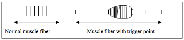 Trigger Point Tips: Trigger Point Overview