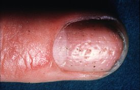 Nail pitting: Nail pitting causes