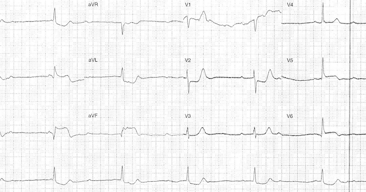 ECG of the Week: ECG of the Week - 22nd May 2017 - Interpretation